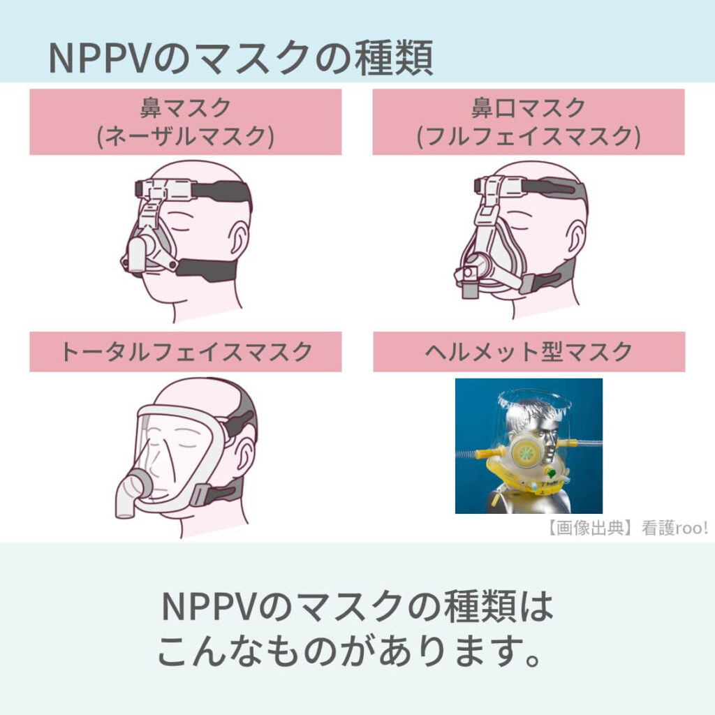 在素NPPV